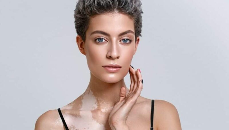 How To Detect Vitiligo? Signs People Should Look Out For - Sound health ...